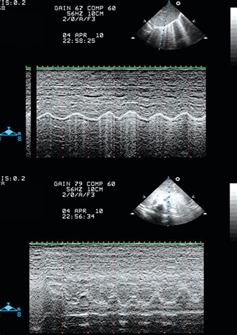 Ultrasound In The Neonatal And Pediatric Intensive Care Unit Clinical Tree Ultrasound In The Neonatal And Pediatric Intensive Care Unit Clinical Tree