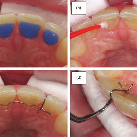 Pdf A Bonding Technique For Fixed Maxillary Retainers