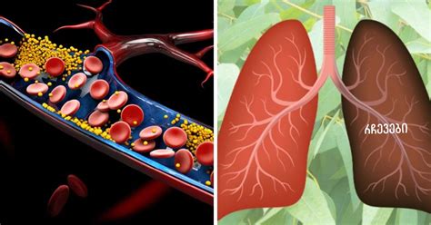 9 მცენარე და ბალახი რომელიც აღადგენს დაზიანებულ ფილტვებს ებრძვის ინფექციებს და აძლიერებს