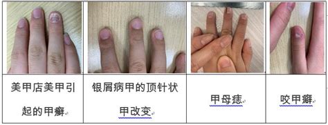 儿医小课堂 93 一个传染俩”的灰指甲该如何预防？澎湃号·政务澎湃新闻 The Paper
