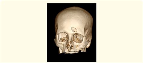 3d Scan Of The Left Frontal Bone Fracture Download Scientific Diagram 3d Scan Of The Left Frontal Bone Fracture Download Scientific Diagram