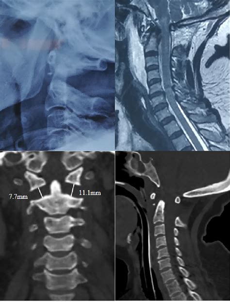 Lateral Cervical Radiography Magnetic Resonance Imaging And Computed