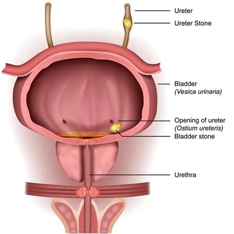 Stone Disease — Restorative Urology Dr Marnique Basto Sydney