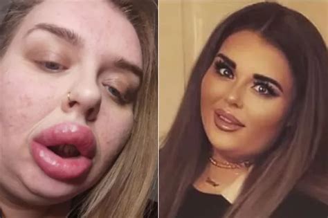 Mum In Hospital After Filler Reaction Leaves Her With Baboons Bum