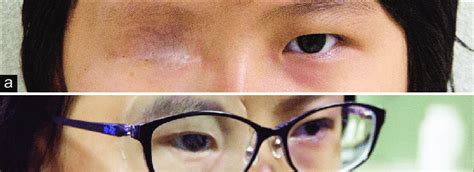 Result Of Prosthetic Fitting A Photograph Before Fabrication Of The