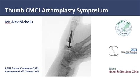 Latest News Basing Hand And Shoulder Clinic Specialist Hand Wrist