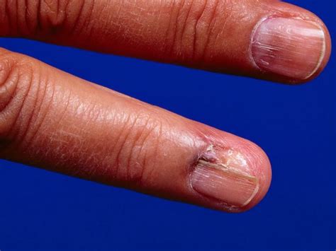 5 Signos Raros De Cáncer De Piel Y Cómo Reconocerlos