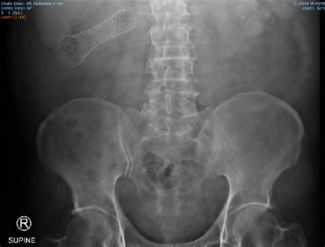 Post Procedure X Ray Colonic Stent Hepatic Flexure Of Colon Download Scientific Diagram