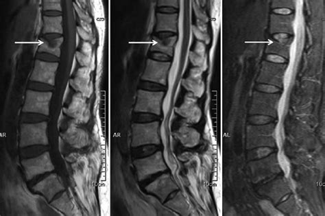 Fisura En La Columna Lumbar Best Sale Varsana