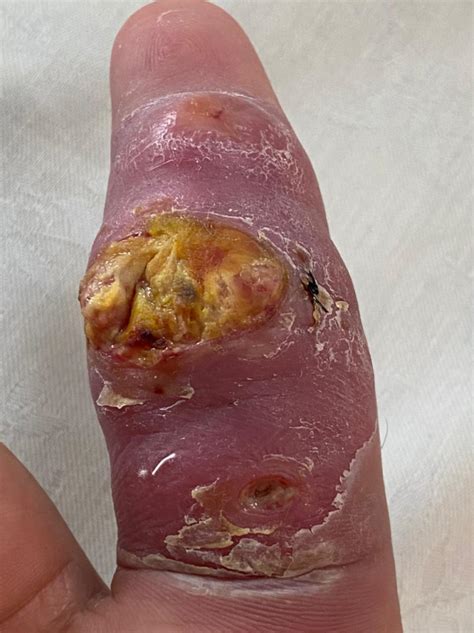 Cutaneous Nontuberculous Mycobacterial Infection After Intra Articular