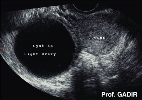 Link Between Ovarian Cysts And Cancer Cancerwalls