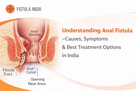 Understanding Anal Fistula — Causes Symptoms And Best Treatment Options