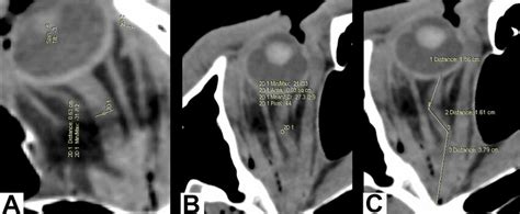 Three Dimensional Multiplanar Reconstruction Indicates A Optic Nerve