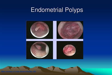Ppt Managing Menstrual Abnormalities Powerpoint Presentation Free