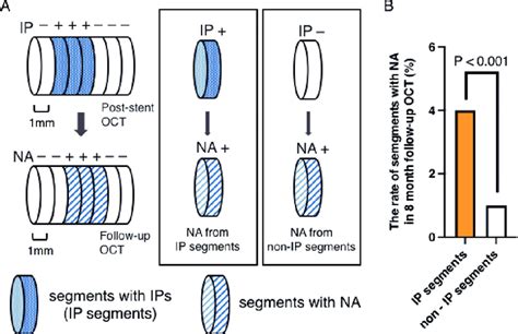 A Segmental Analysis For Irregular In Stent Protrusions Ip And