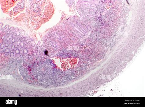 Histopathology Of Chronic Appendicitis Light Micrograph Photo Under