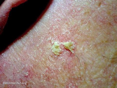 Types Of Skin Lesion Pictures Causes And Treatment