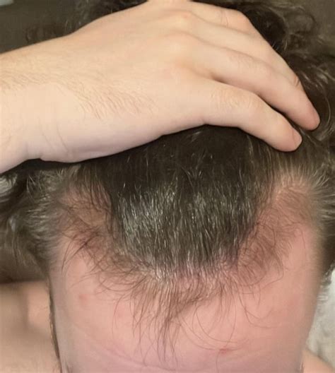 6 Month Progress Update Min Fin Derma Rolling 05 Mm Rtressless