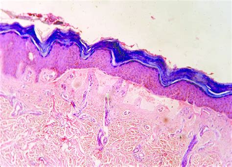 Histopathology Showing Sub Epidermal Cell Poor Bulla With Festooning