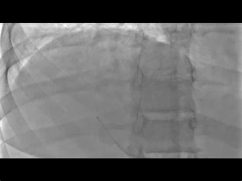 Right And Segment Iv Portal Vein Embolization Accomplished With Glue Nbca… José Hugo Luz 29