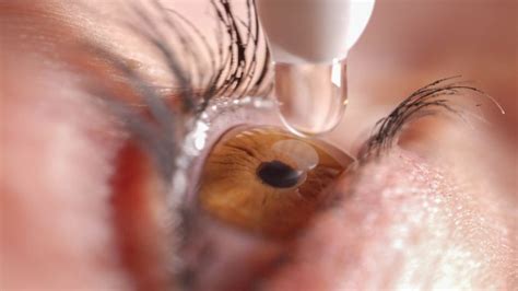 Optometry Advisor On Linkedin New Contact Lens Associated Keratitis