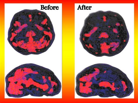 Ppt Irlen Syndrome And Visual Stress Powerpoint Presentation Free