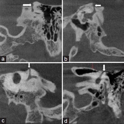 Use Of Cone Beam Computed Tomography In The Diagnosis Of Superior