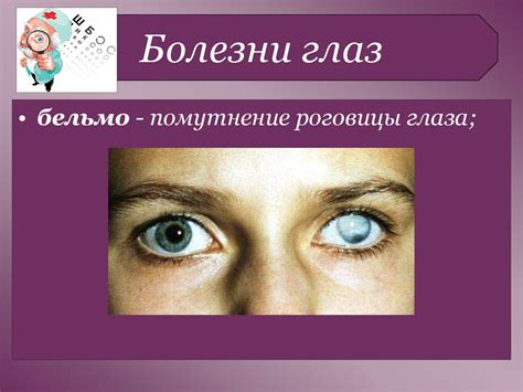 Гигиена зрения. Предупреждение глазных болезней - презентация онлайн