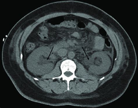 Ct Abdomen Depicts Bilateral Hydronephrosis And Diffuse Retroperitoneal Download Scientific
