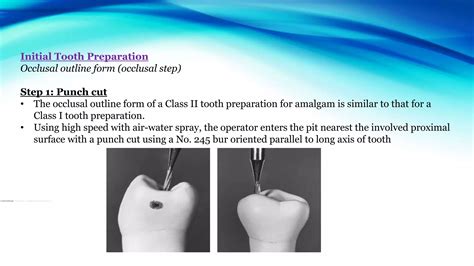 Amalgam Cavity Preparation Pptx