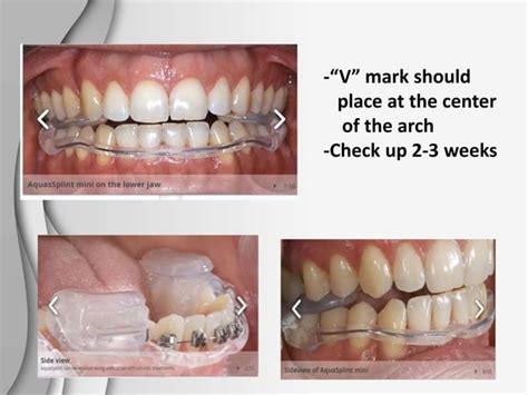 Aqua Splint Universal Therapy Tmj Orthodonticspptx