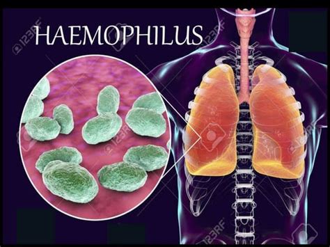 Candidiasis Clinical Manifestations And Lab Diagnosis Of Oral Candi