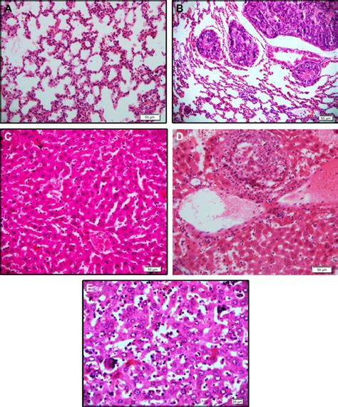 Normal Lung Tissue Vs Cancerous Lung Tissue Cancerwalls