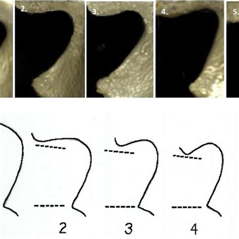 Comparison Of Greater Sciatic Notch Score Distribution For A Australian Download Scientific
