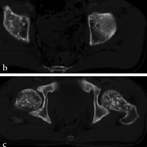 Millimetric Hyperdense Sclerotic Foci In The Sacrum Acetabulum And Download Scientific