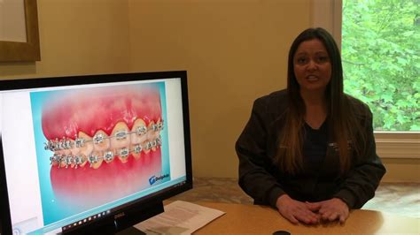 Decalcification Of Teeth During Orthodontic Treatment Youtube
