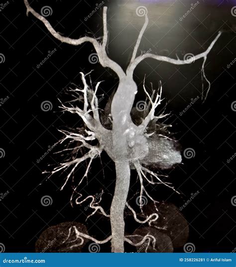 Ct Angiography Computed Tomography Angiography Cta Of Abdominal