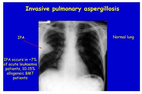 Aspergillus Introduction Classification Colony Morphology Patho