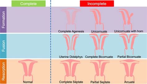 Müllerian Duct Anomalies Abnormalities Can Develop From Problems With
