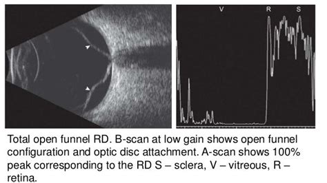 B Scan