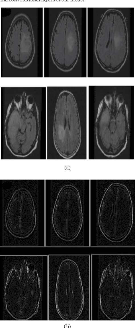 Figure 1 From A Deep Transfer Learning Based Architecture For Brain