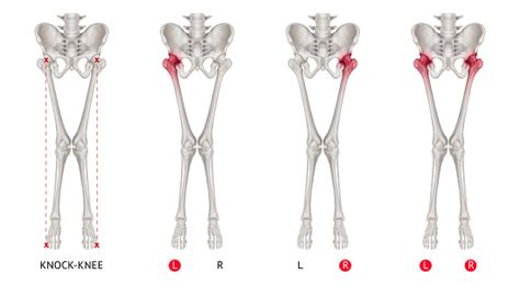 Valgus Alignment Leg Or Knockknee Red Highlights On Hip Joint Area Medical Illustration