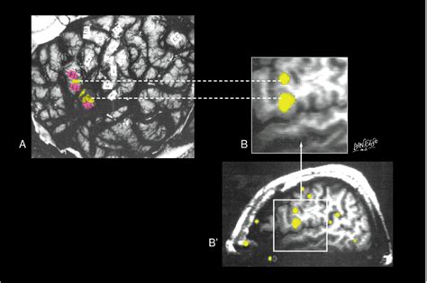 Comparison Of A Photographic Recording Of Intraoperative Mapping A
