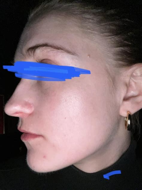 Routine Help Differin Gel And Bp Wash Purge Rskincareaddiction