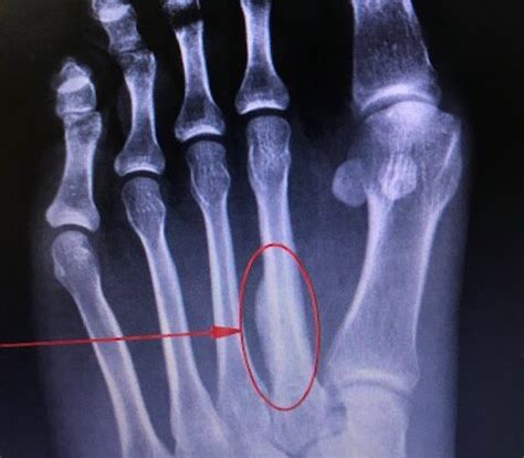 March Fracture Metatarsal Stress Fractures Md Searchlight