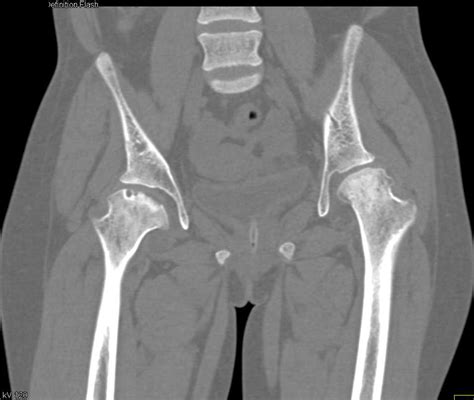 Avascular Necrosis Avn In Patient With Hip And Acetabular Deformities