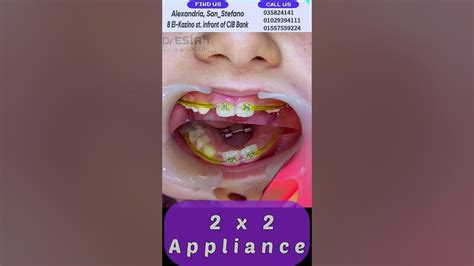 2x2 Orthodontic Appliance Maxilla Expander Youtube
