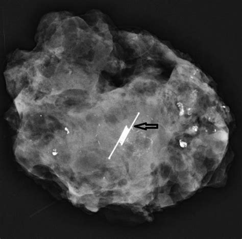 Reflector Guided Localization Of Non Palpable Breast Lesions The First