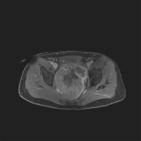 Primary Choriocarcinoma Presenting As A Large Pelvic Mass Ct And Mri