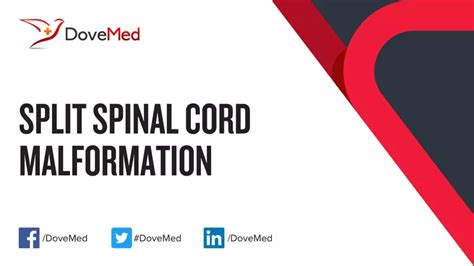 Split Spinal Cord Malformation Dovemed